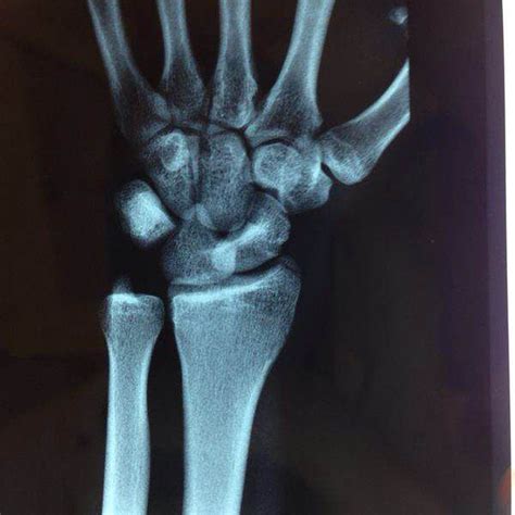 Retro Lunate Dislocation 6 Months Ago Forum 2014
