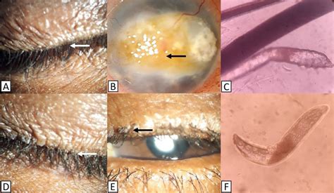 Varied Presentations Of Ocular Demodicosis In A Rural Population Bmj