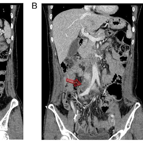 Distant Lymph Node Metastasis After Anastomosis Site Colectomy And