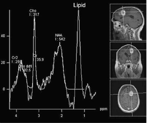 The Single Voxel Short Te 1 H Mrs Corresponding To Fig 9 Demonstrates Download Scientific