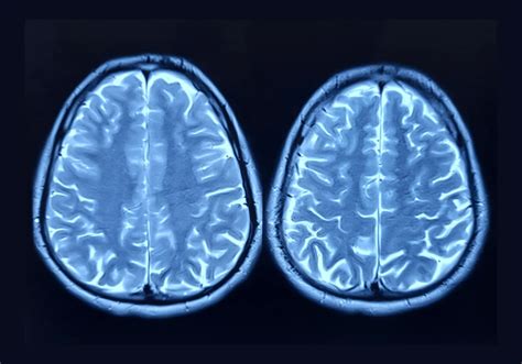 Optimising Multimodal Prompts For Gpt 4v In Brain Mri Diagnosis