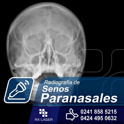 Radiografía De Los Senos Paranasales La Radiografía De Waters Es La