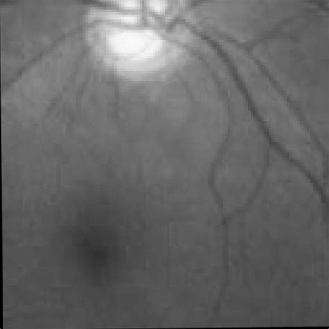 Retinal Disease Detection Object Detection Model V7 2024 06 20 1 56pm By Akhin