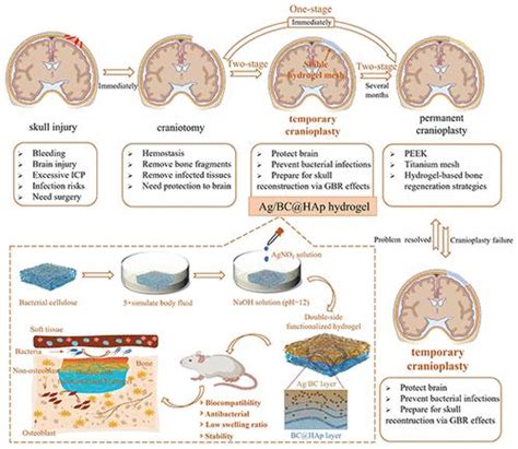 用于临时颅骨修补术的双面功能化银纳米粒子 细菌纤维素 羟基磷灰石水凝胶网的仿生设计 Acs Applied Materials And Interfaces X Mol