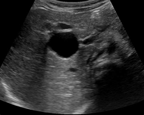 Liver Atlas Case 215 Choledochal Cyst