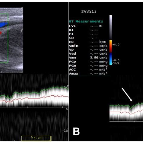Surgical Procedures Of Open Splenectomy A Initial Skin Incision Was Download Scientific
