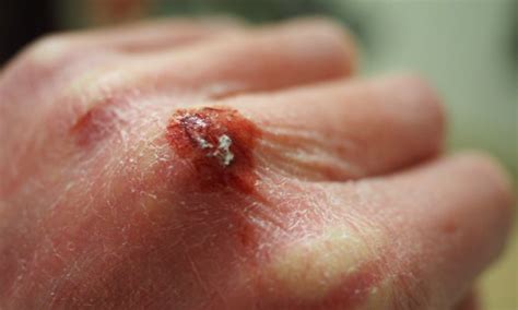 Sinoderm Gel Šta Je Kako I Za šta Se Koristi Mogući Rizici Permadent