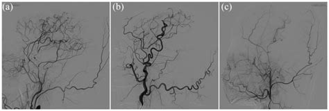 Association Between Angiographic And Clinical Outcomes After Sta Mca