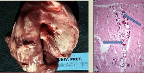 Calcification Pathology Flashcards Quizlet