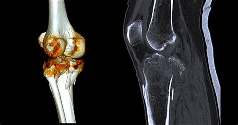 외상 사례에서 경골 및 비골 골절의 Ct 영상 경골과 비골의 외상성 골절을 강조하는 상세한 Ct 스캔으로 뼈 변위와 손상을 보여줍니다 0명에 대한 스톡 사진 및 기타 이미지