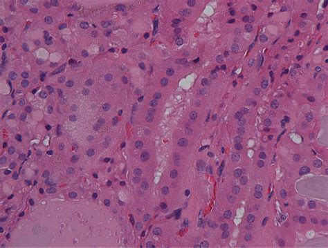 Isolated Multifocal Sclerosing Thyroiditis Case Report