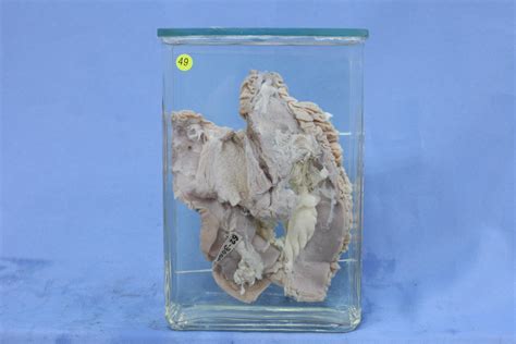 消化疾病22 49 华特氏壶腹部癌