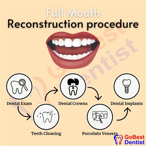 Full Mouth Rehabilitation Smile Designing Gobest Dentist