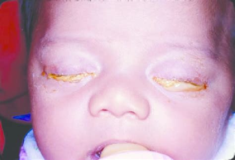 Neonatal Gonococcal Conjunctivitis Conjunctivitis Skin Deep