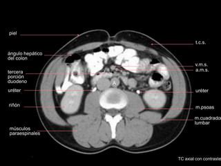 Anatomia RadiolÓgica De Abdomen Por Tomografia Pdf