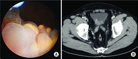 Typical Findings Of Extensive Type Cystitis Glandularis On Cystoscopy Download Scientific