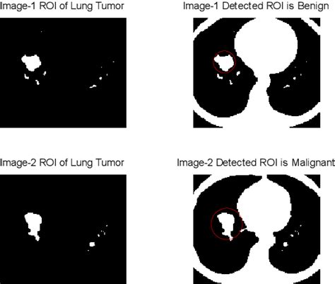 Figure 7 From Lung Cancer Detection And Classification Using Ct Scan