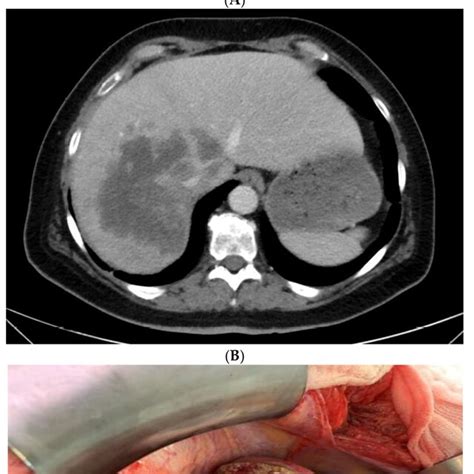 A 55 Year Old Female Patient With Cholangiocarcinoma And Nodular Download Scientific Diagram