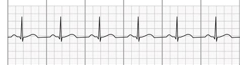 Ekg Normal Sinus Rythms Sinus Bradycardia And More Leveluprn