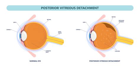 Retina Conditions Atwal Eye Care Retina Doctor Cheektowaga Atwal