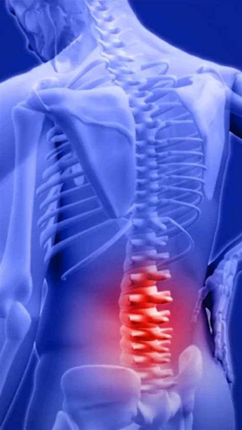 Trigger Point Therapy Treating The Iliopsoas Group Artofit