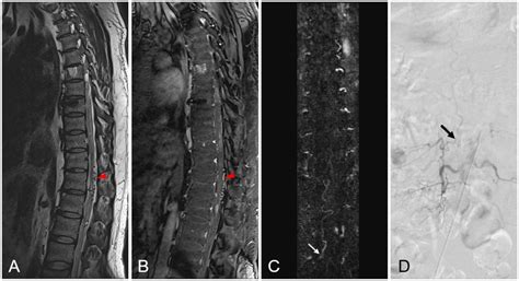 Frontiers Mri Characteristics Of Lumbosacral Dural Arteriovenous Fistulas
