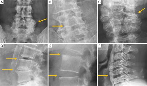 Osteophytes Lumbar