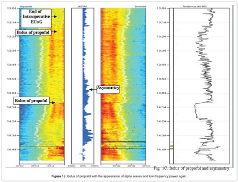 Neurorehabilitation Bolus Propofol