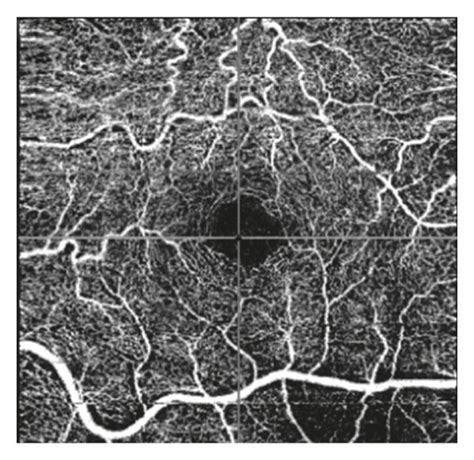 Optical Coherence Tomography Oct And Oct Angiography Of The Eyes With Download Scientific