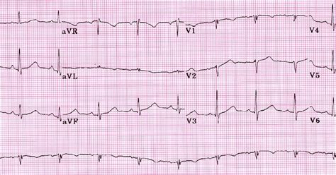 Study Medical Photos Qt Interval Prolongation On Ecg