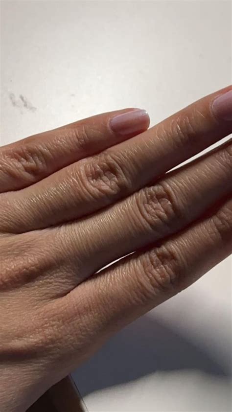 Does This Look Like Scleroderma R Scleroderma