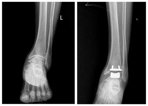 Шагайн хиймэл үе солих мэс заслыг ГССҮТ ийн эмч нар эх орондоо