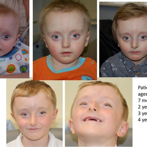 Facial Dysmorphism In Patient 1a Aged 7 Months 2 Years 3 Years And