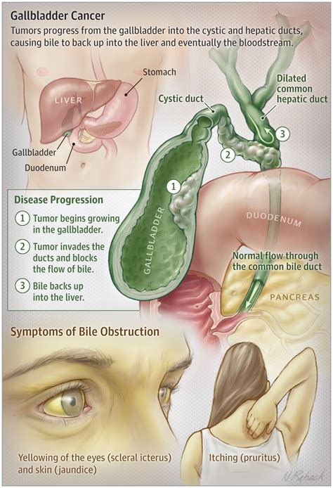 Diagram Bismuth Corlette Classification Of Perihilar Cholangiocarcinoma