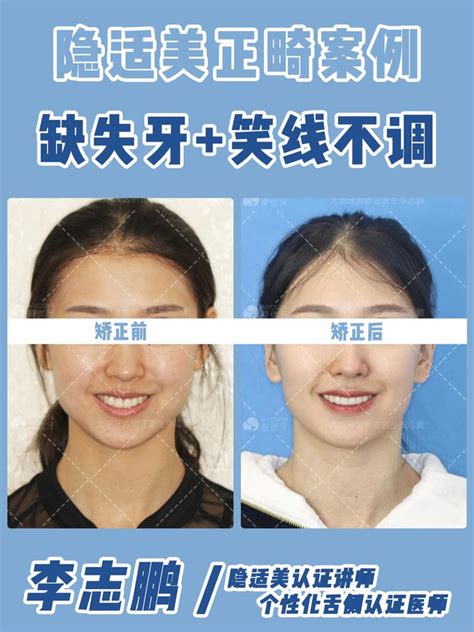 北京牙齿矫正隐适美正畸缺失牙笑线不调 案例分享 知乎
