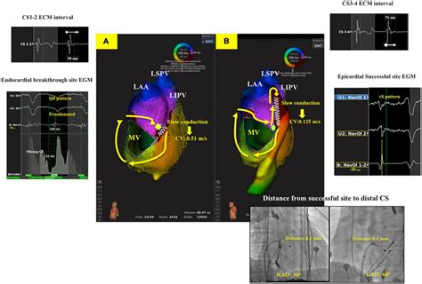 Ultra High Density Mapping During Perimitral Afl In A Patient With Download Scientific Diagram