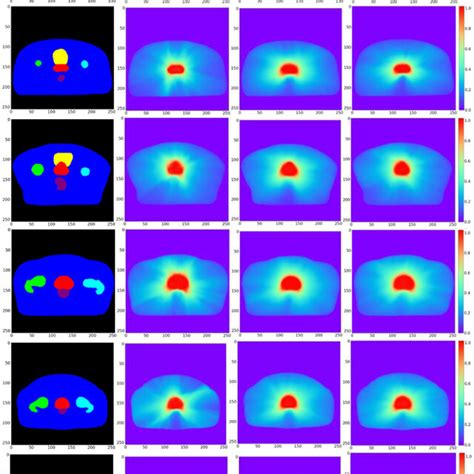 Comparison Of Predicted Dose Distributions Between Contours Based