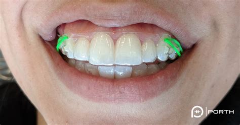 Orthodontic Elastics Invisalign At Sherry Stamps Blog