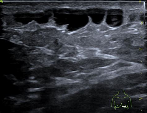 Clinical And Ultrasound Features Of Mondors Disease Of The Breast A