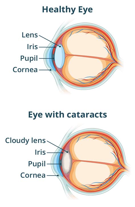 Eye Diseases Cataract