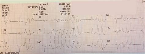 Hyperacute T Waves And Serial Ecgs In Early Acs Av Blocks And More On Sustained Vs