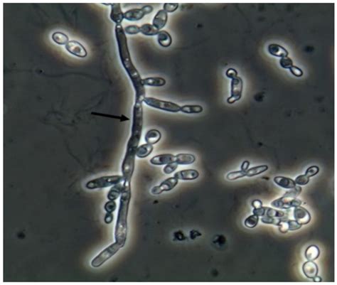 Candida Albicans Pseudohyphae In The Fresh And Unstained Urine Download Scientific Diagram