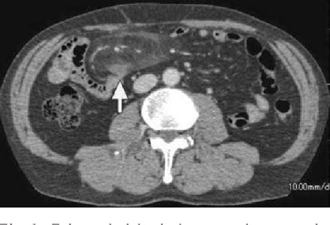 Figure 1 From A Case Of Sclerosing Mesenteritis Detected By Fdg Pet