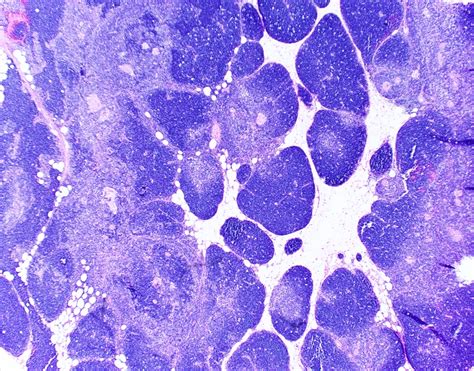 Thymic Hyperplasia Immunotherapy At Jorge Damon Blog