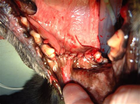 Mandibulectomy Segmental — Dr Julius M Liptak