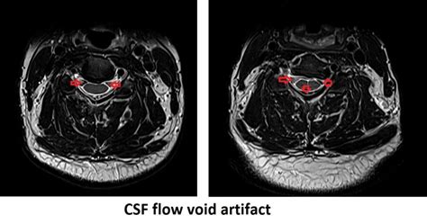 Flow Artifact Mri Csf Flow Artifact