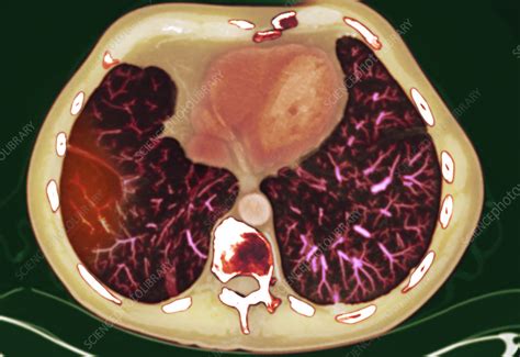 Emphysema Ct Scan Stock Image C059 9673 Science Photo Library
