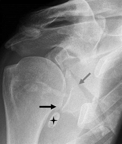 Glenoid Fossa Fracture X Ray At Billy Gamboa Blog