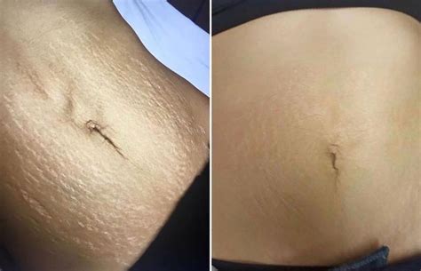 Laser Stretch Mark Removal Does It Really Work