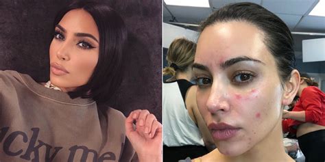 Kim Kardashian Talks About Her Psoriasis With Photos PS Beauty